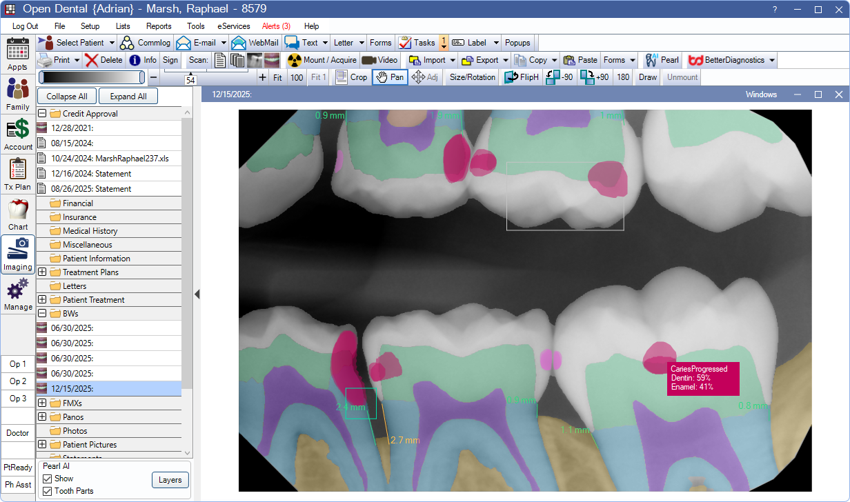 Open Dental Software - Pearl Process